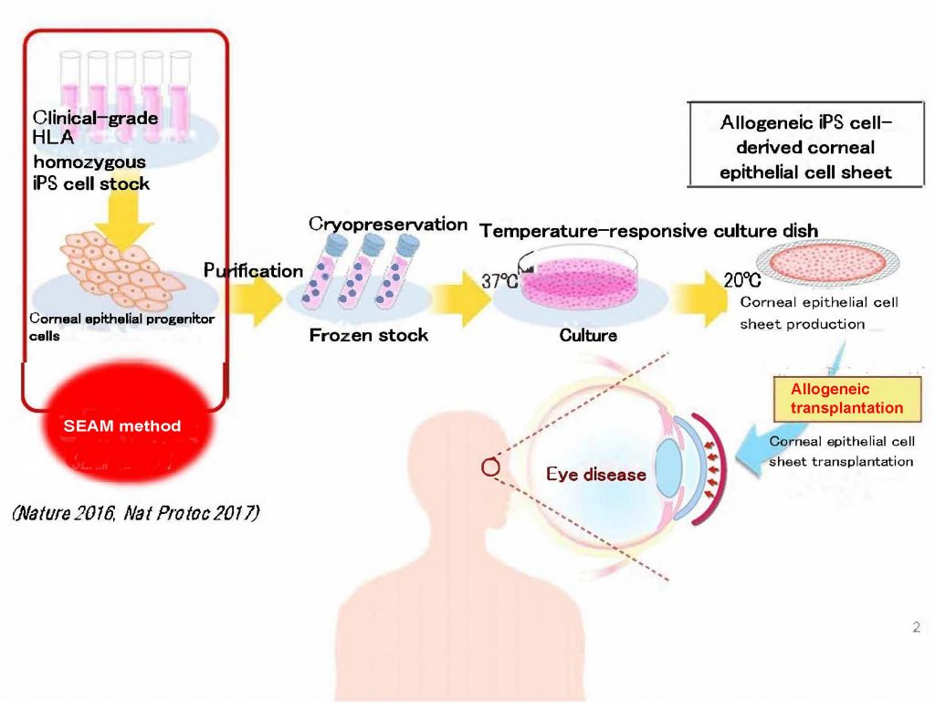World’s first transplant of cornea made from iPS cells | Graduate ...