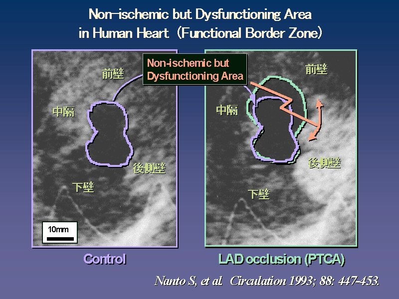 Non-ischemic but Dysfunctioning Area